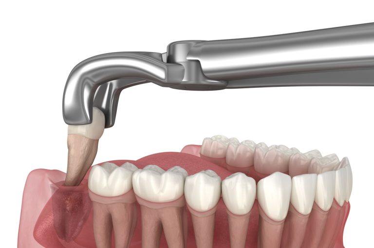 Wisdom Teeth Removal: What Are the Best Recovery Tips for a Speedy Healing?